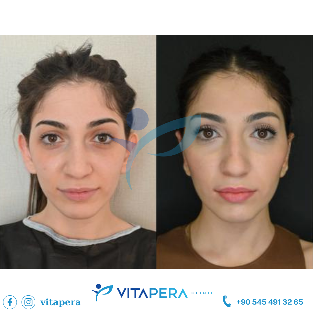 Ear Aesthetics (Ear Lift / Otoplasty) in Turkey | Vitapera