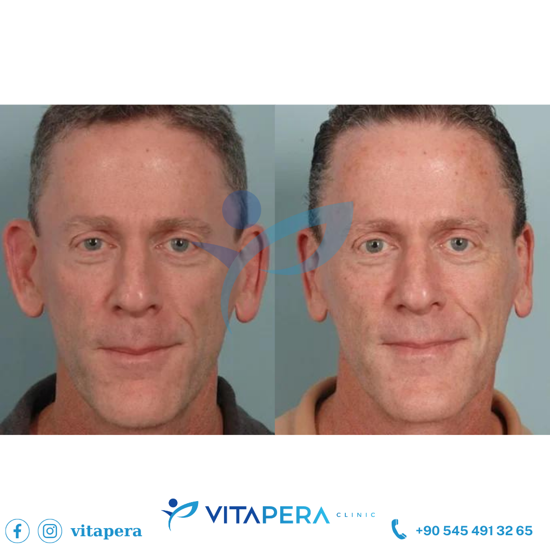 Ear Aesthetics (Ear Lift / Otoplasty) in Turkey | Vitapera